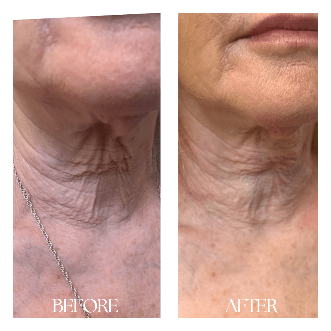 Erbium Laser Resurfacing - New Medical Spa