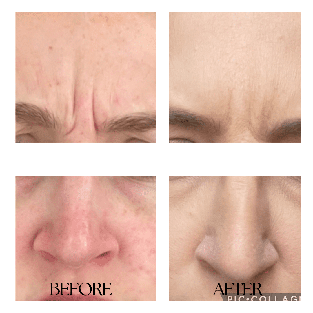 Botox® / Xeomin® - New Medical Spa