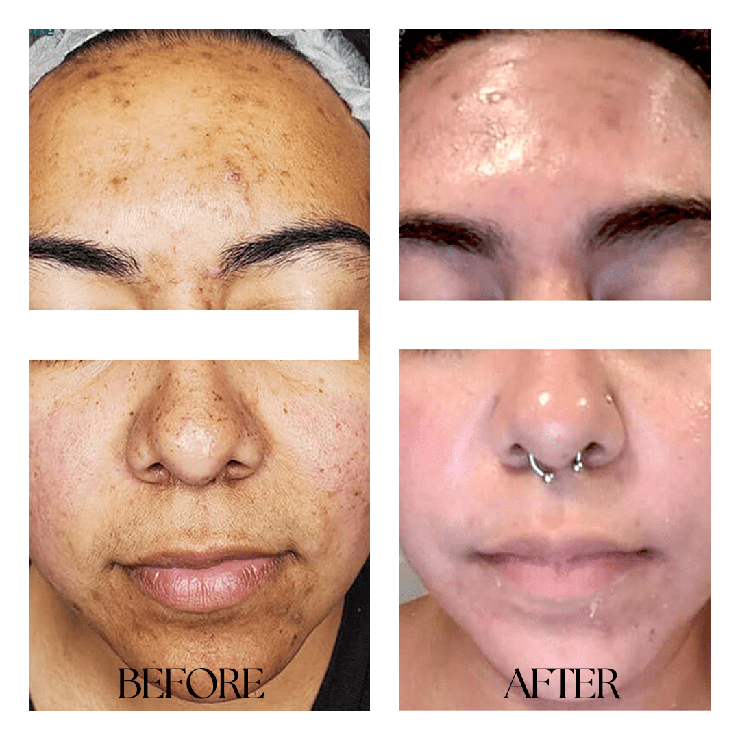 Chemical Peel - New Medical Spa