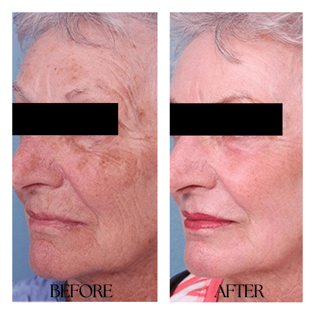 IPL Skin Resurfacing - New Medical Spa