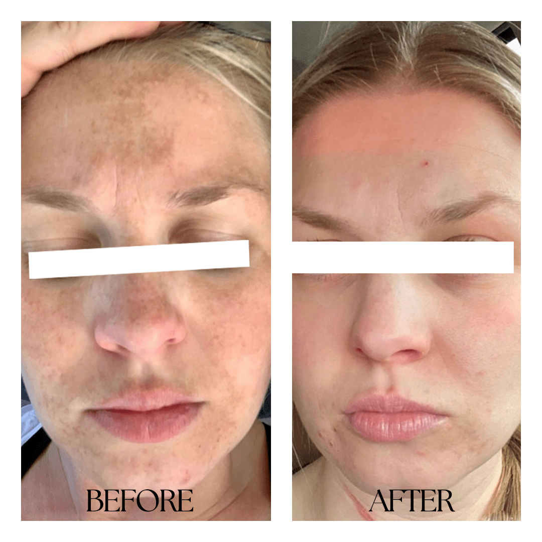 IPL Skin Resurfacing - New Medical Spa