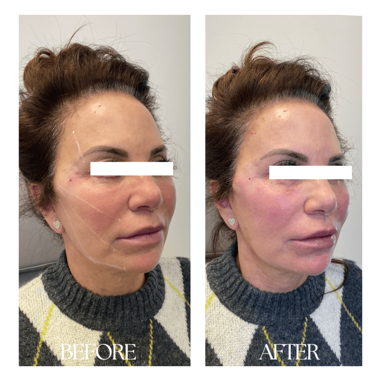 PDO Threads: Body and Face - New Medical Spa