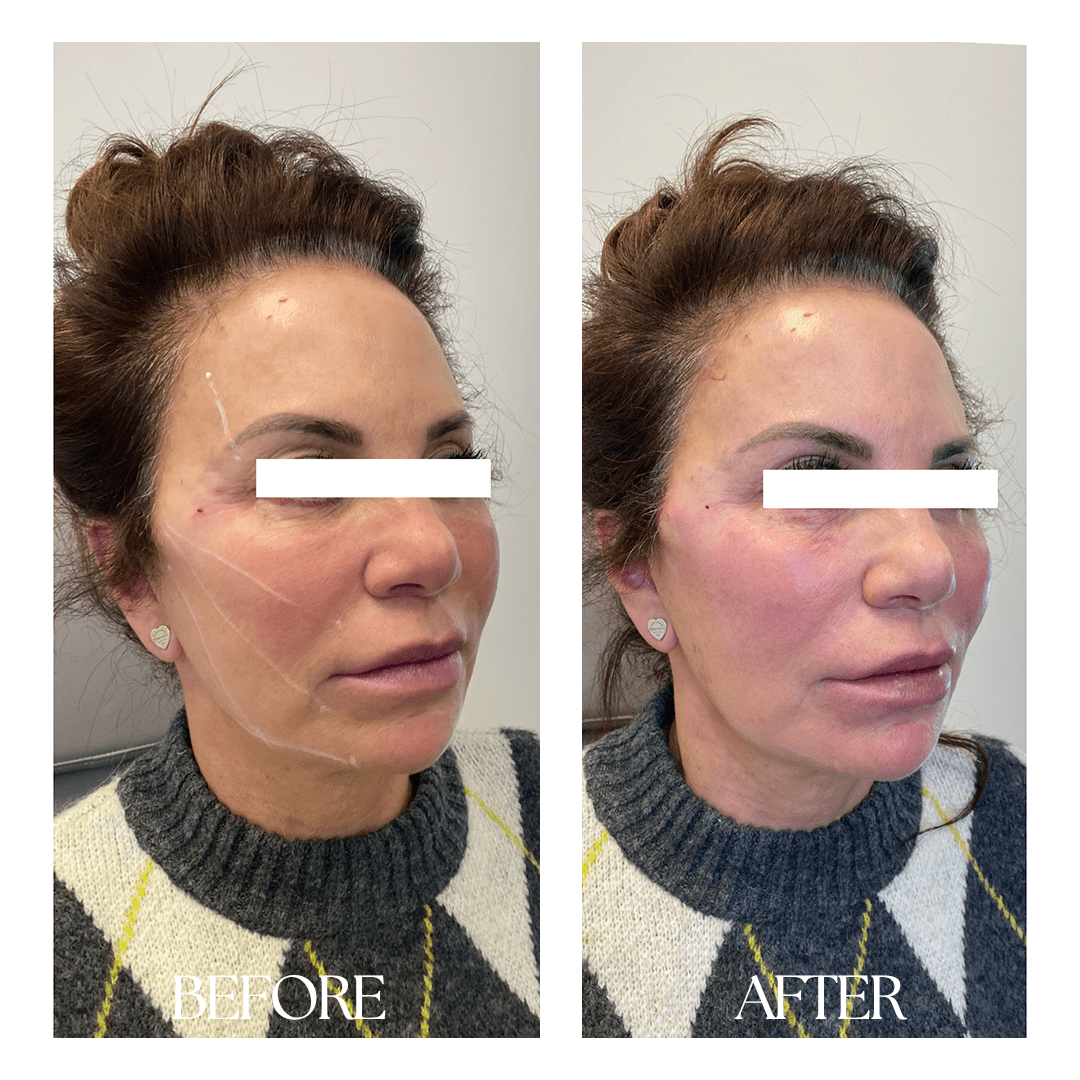 PDO Threads: Body and Face - New Medical Spa