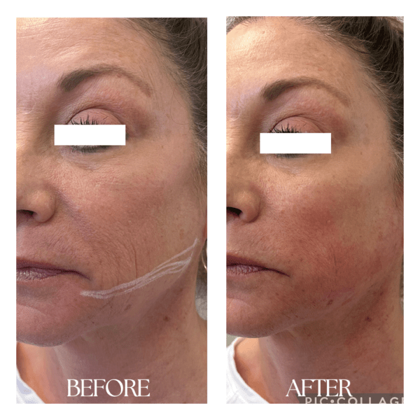 PDO Threads: Body and Face - New Medical Spa