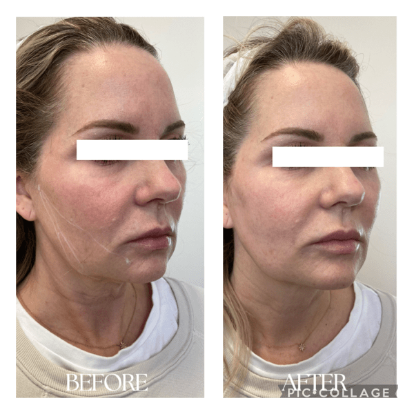 PDO Threads: Body and Face - New Medical Spa