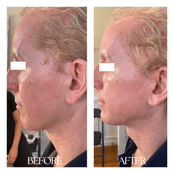 PDO Threads: Body and Face - New Medical Spa