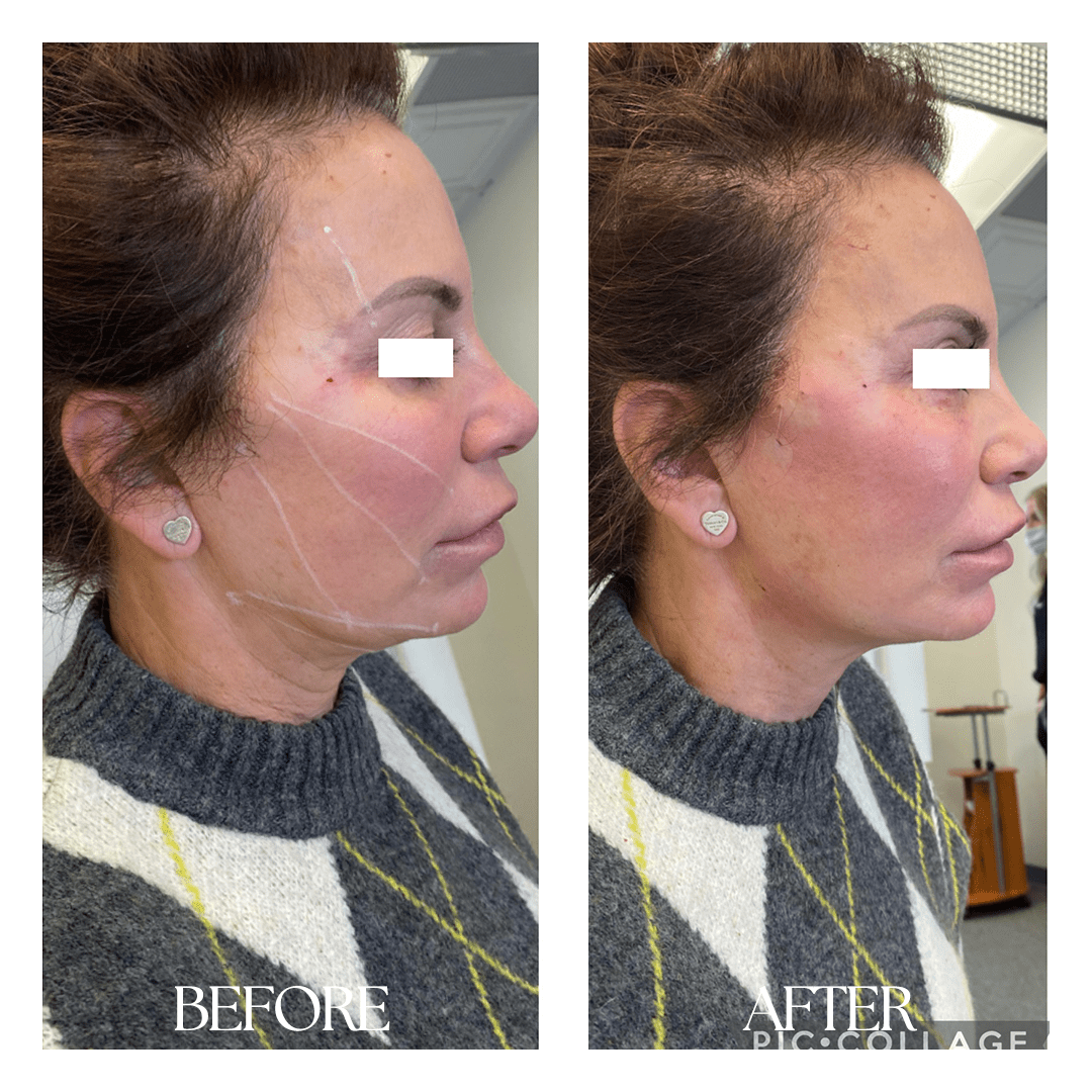 PDO Threads: Body and Face - New Medical Spa