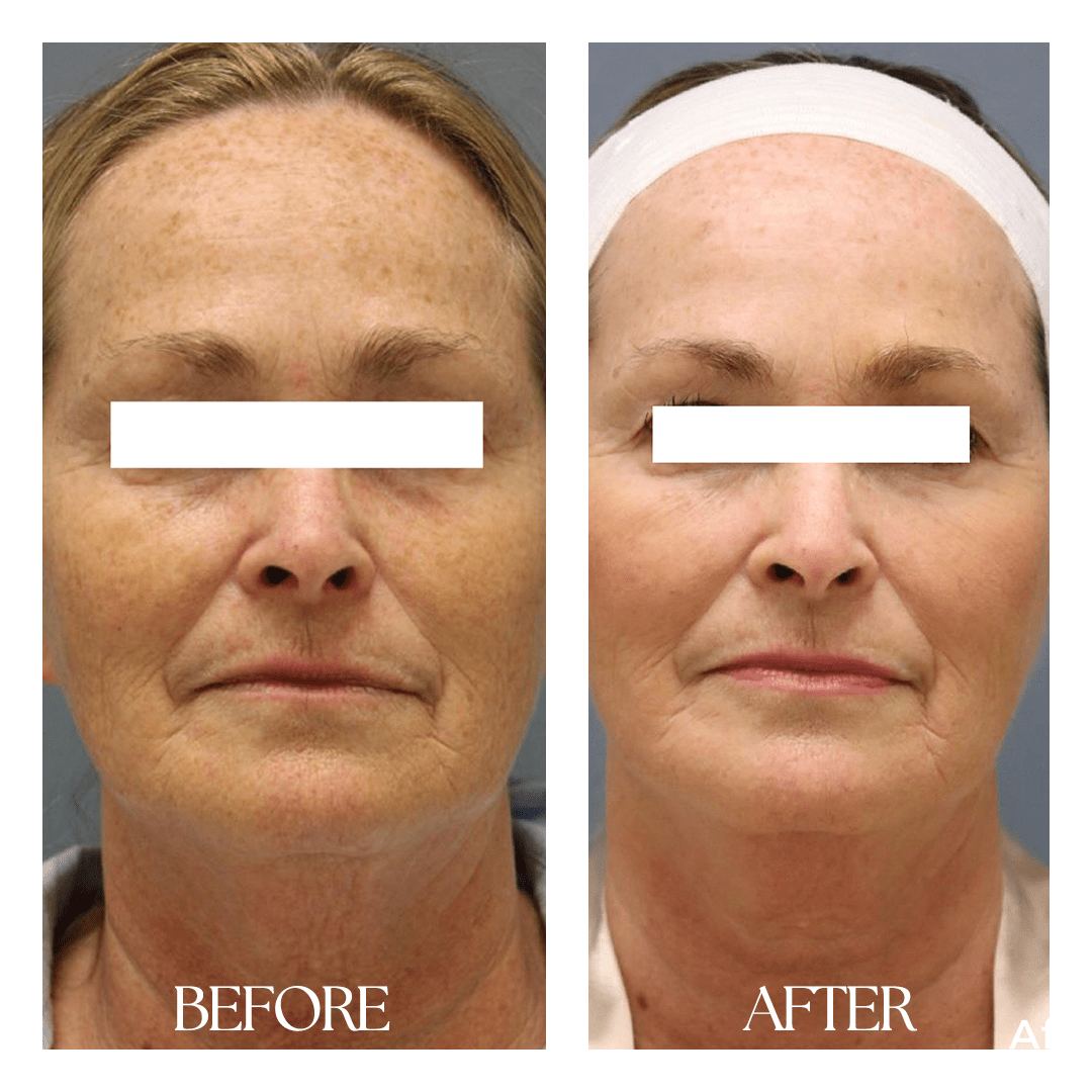 PiXel8-RF Microneedling - New Medical Spa