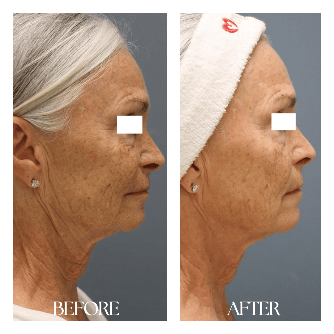 PiXel8-RF Microneedling - New Medical Spa