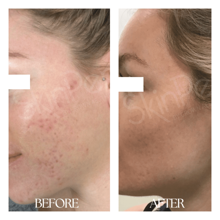 SkinPen® Microneedling - New Medical Spa