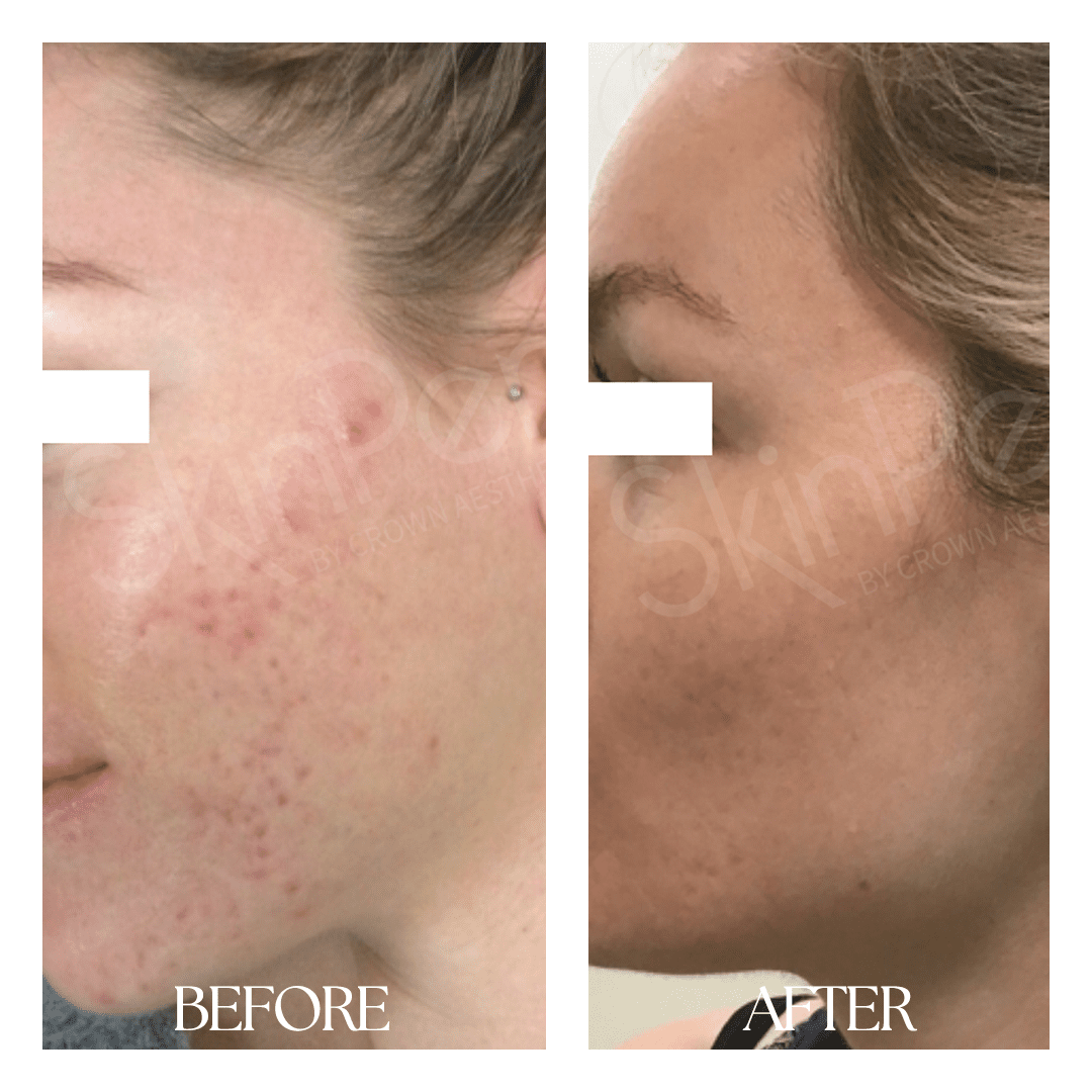 SkinPen® Microneedling - New Medical Spa