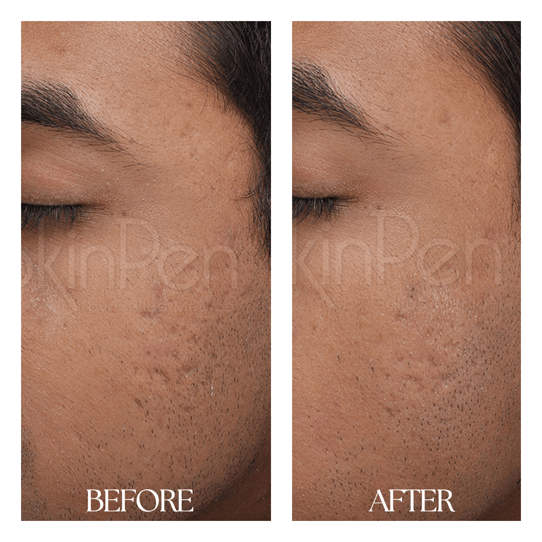 SkinPen® Microneedling - New Medical Spa