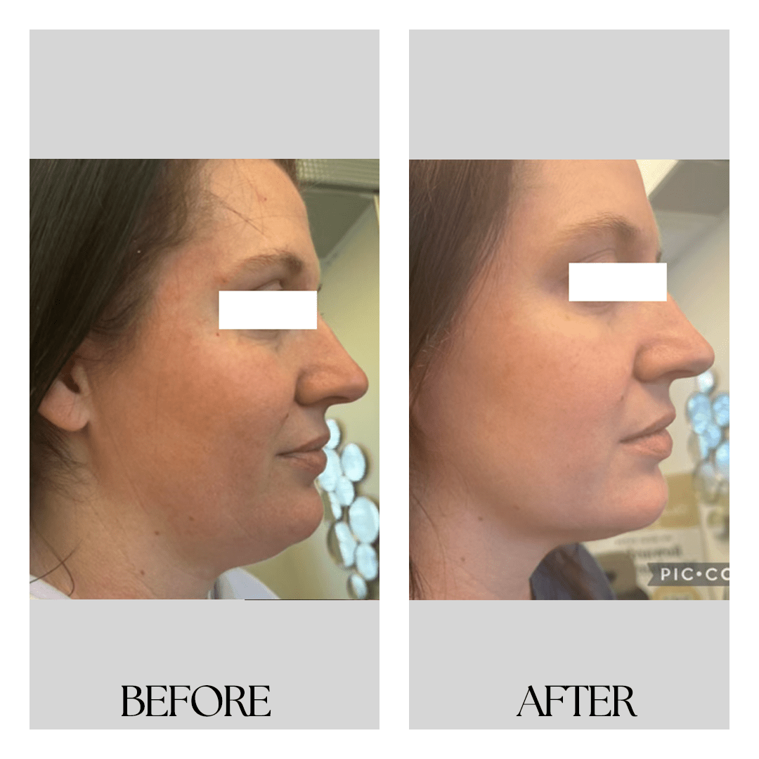 Ultherapy®: Body and Face - New Medical Spa