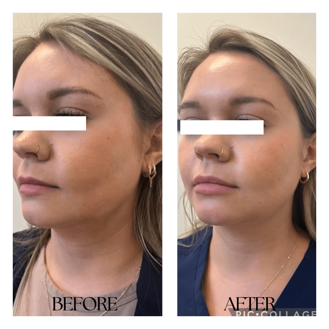 Ultherapy®: Body and Face - New Medical Spa