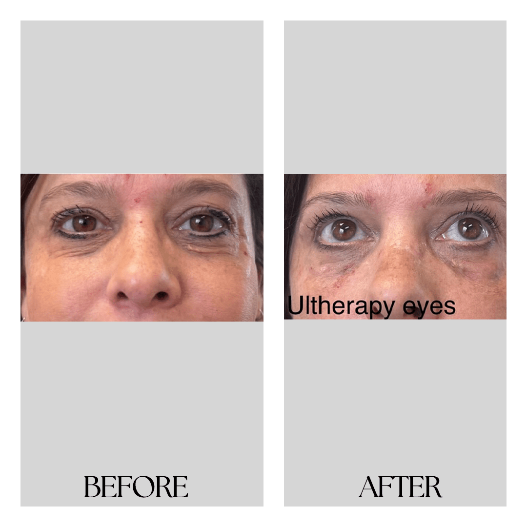 Ultherapy®: Body and Face - New Medical Spa