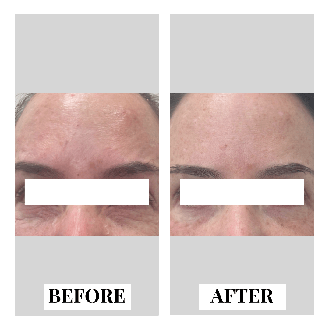 Undereye Filler Treatments - New Medical Spa