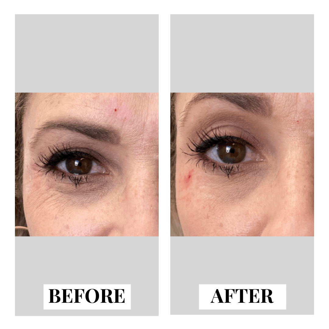 Undereye Filler Treatments - New Medical Spa