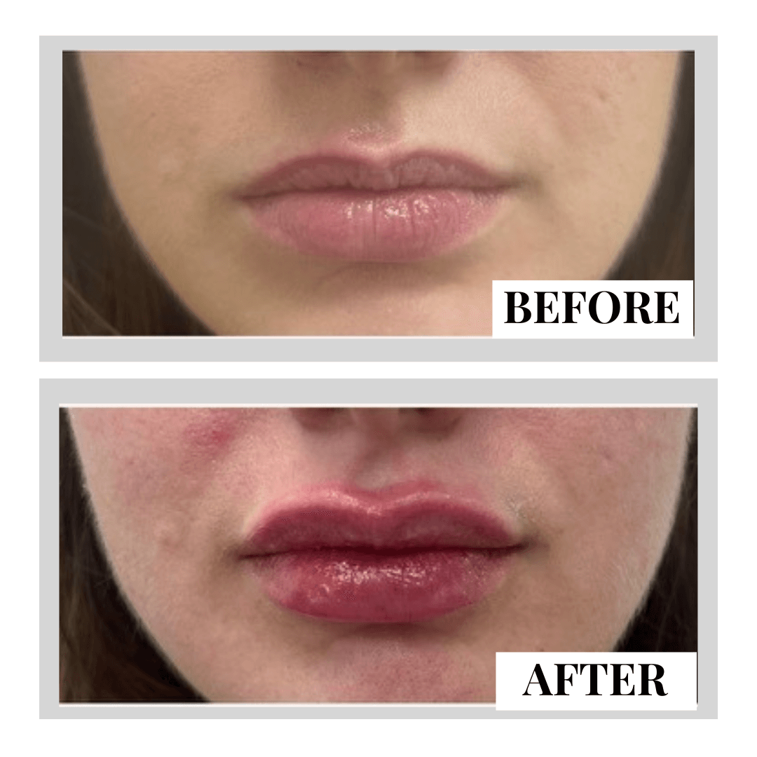 Lip Filler - New Medical Spa