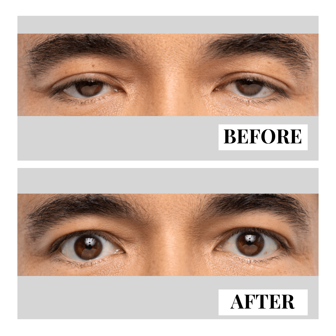 Droopy Eyelid - New Medical Spa