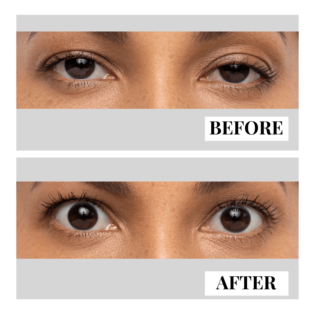 Droopy Eyelid - New Medical Spa