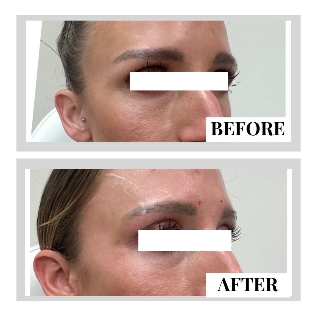 Solutions to Treating Sagging Eyebrows - New Medical Spa