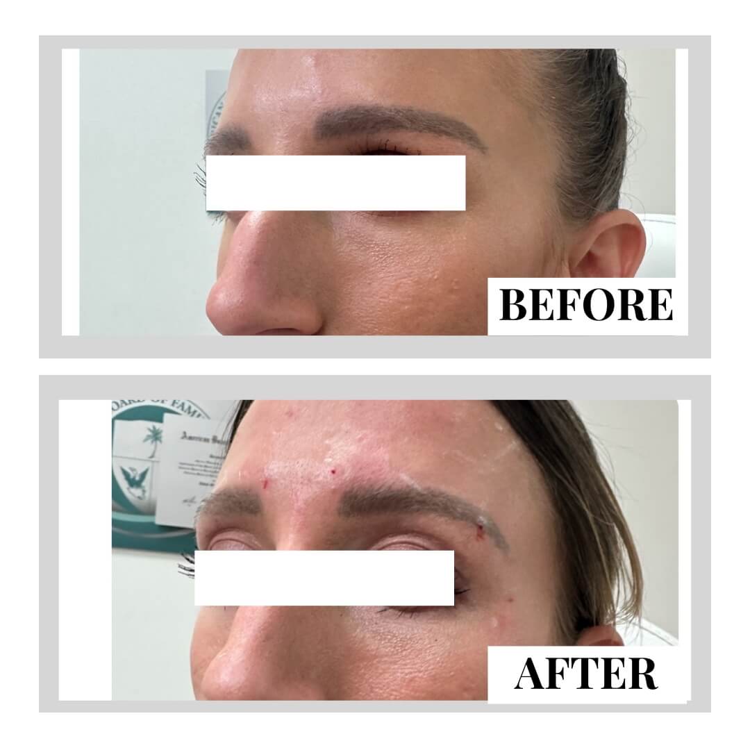Solutions to Treating Sagging Eyebrows - New Medical Spa