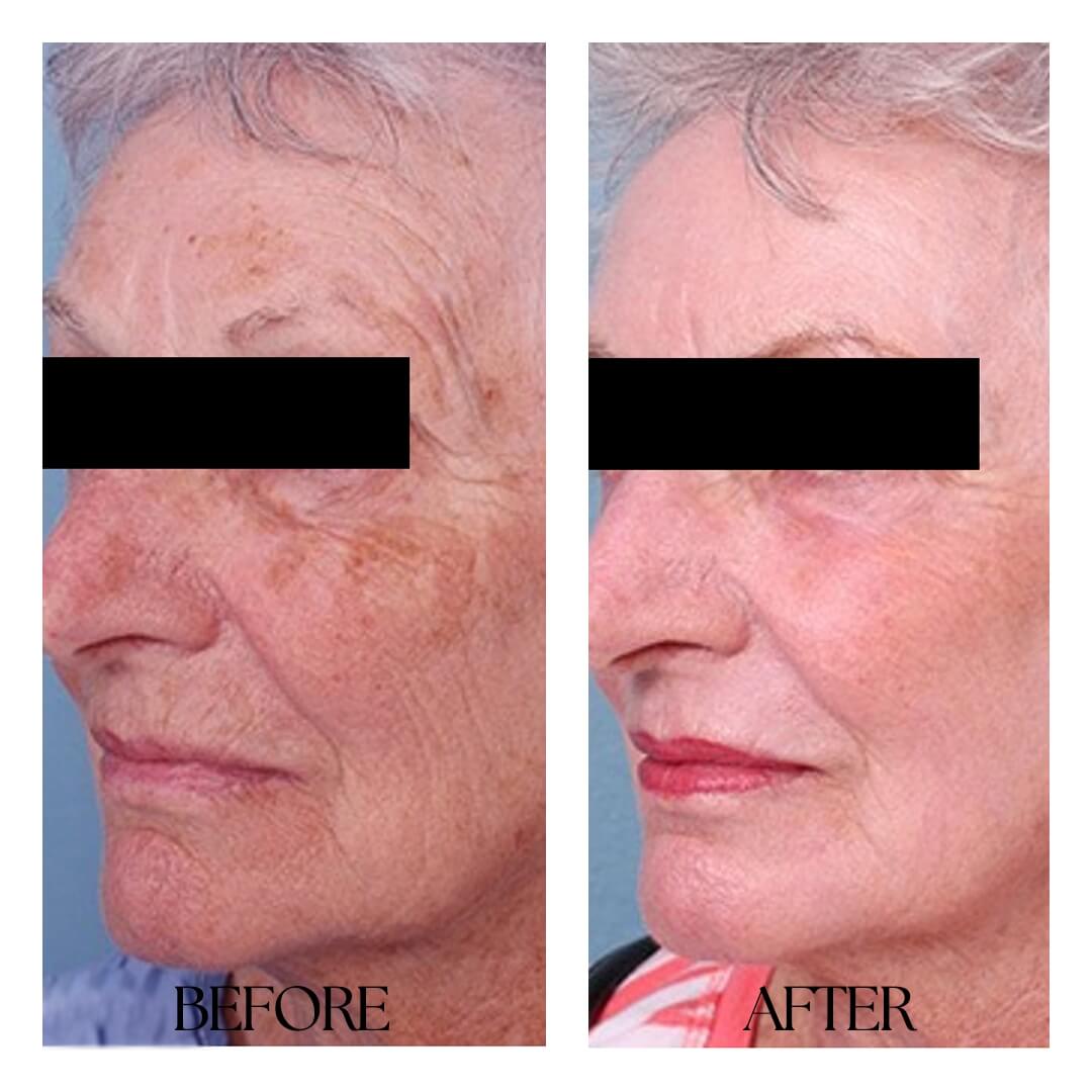 Acne Scars / Scars - New Medical Spa