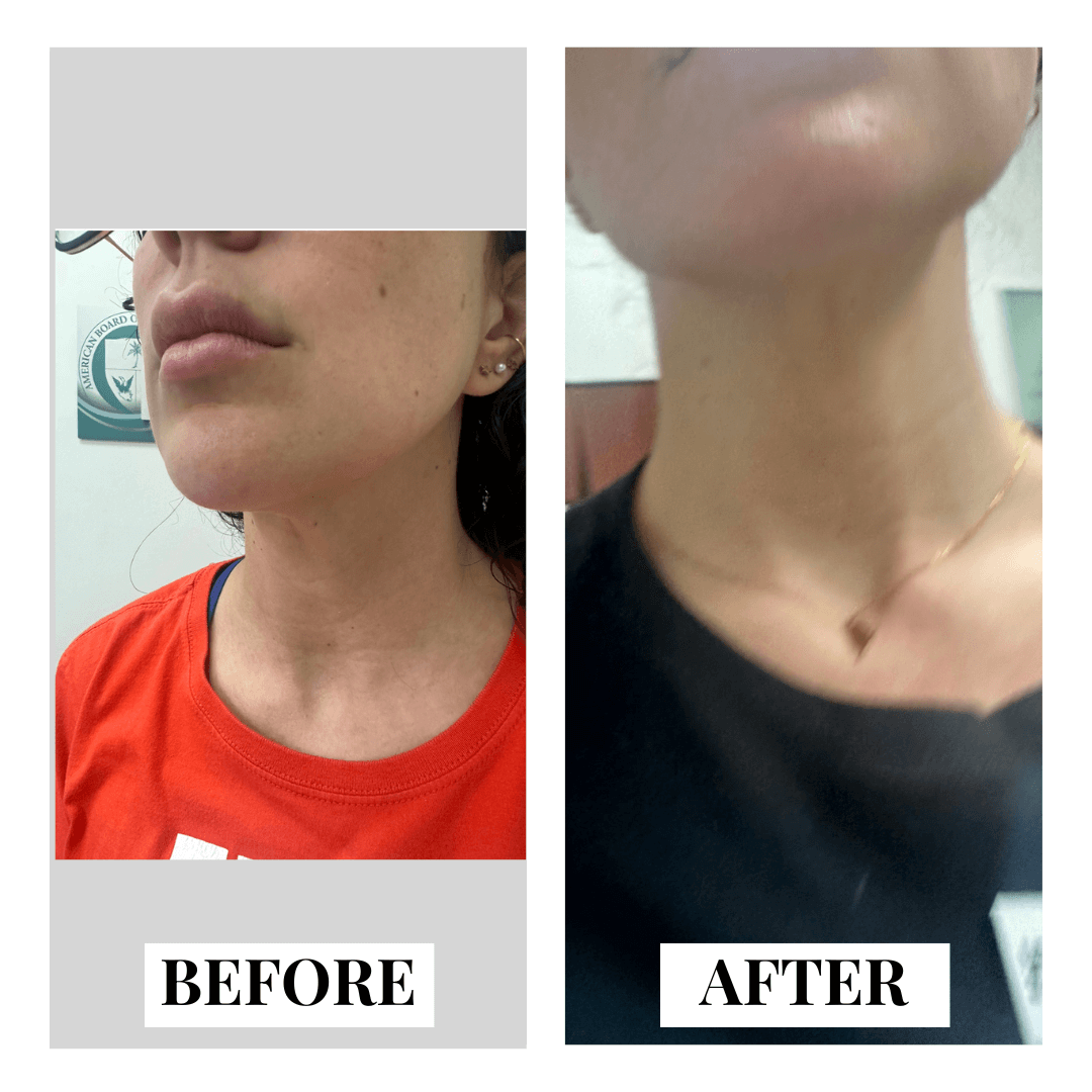 Tech Neck / Neck Lines - New Medical Spa