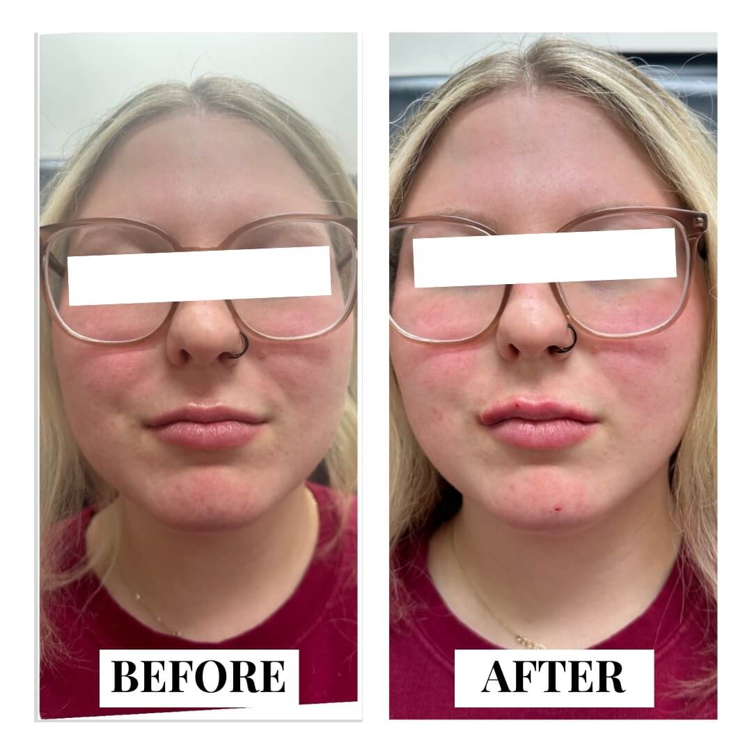 Solutions for Thin Lips in Short Pump - New Medical Spa