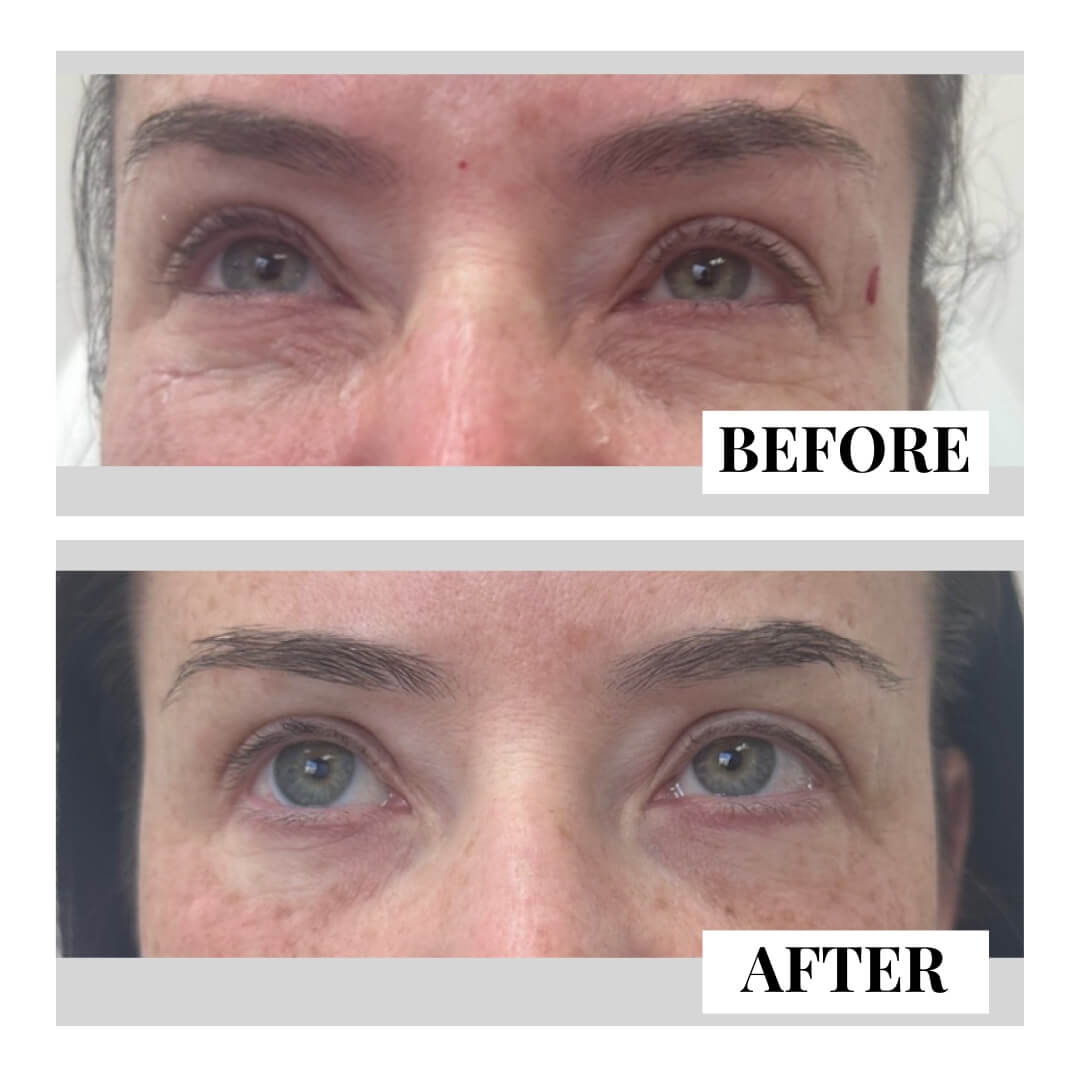 Under Eye Hollows / Dark Circles - New Medical Spa