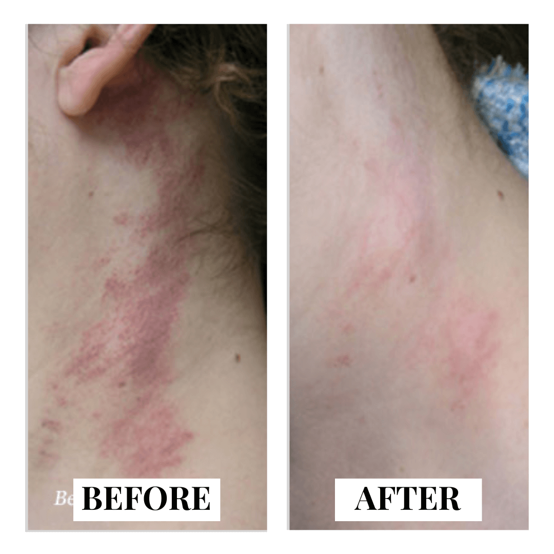 Broken Blood Vessels Body Treatment - New Medical Spa