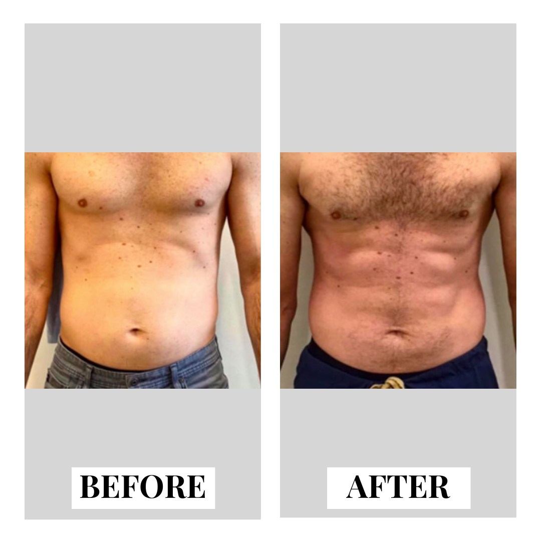 Excessive Fat Treatment - New Medical Spa