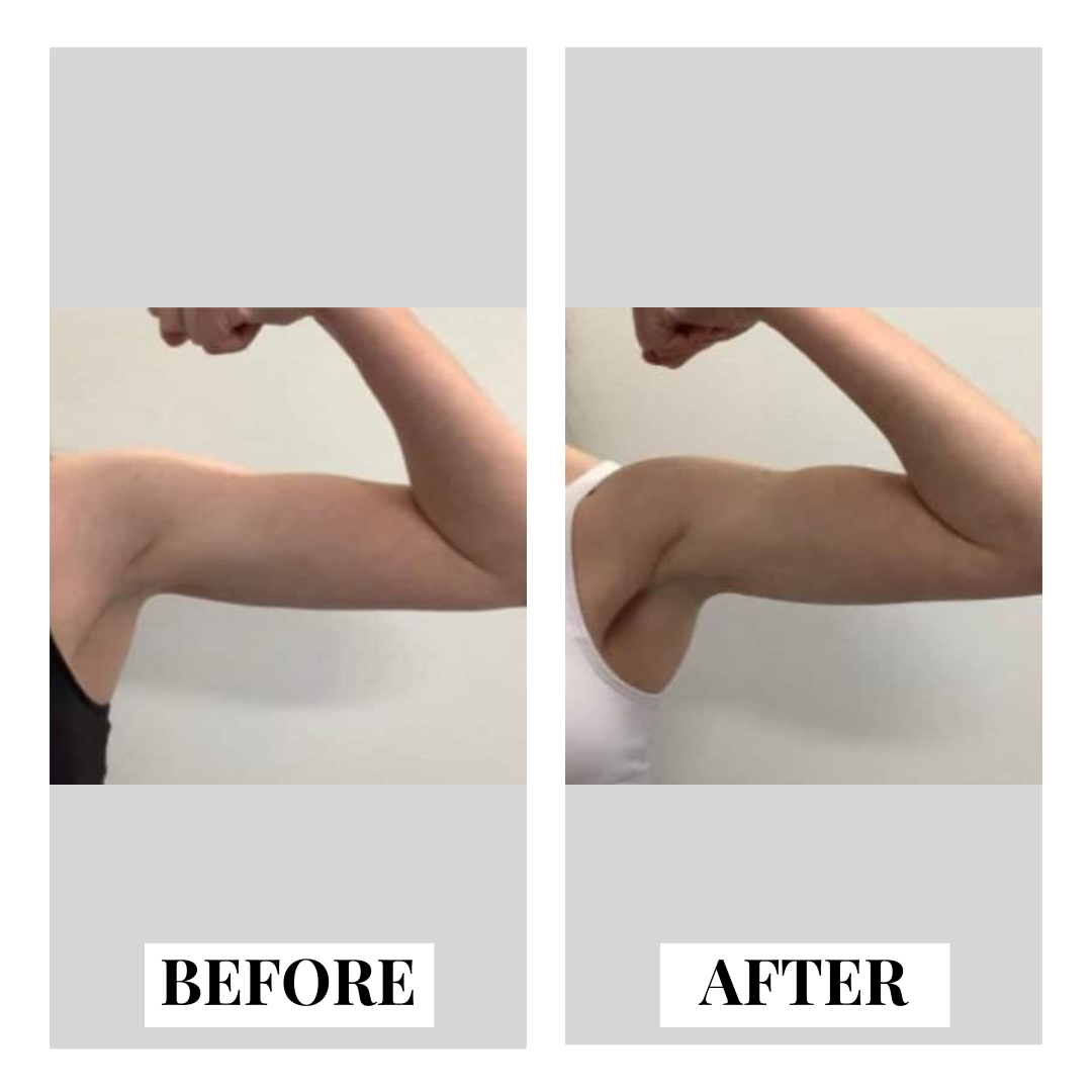 Excessive Fat Treatment - New Medical Spa