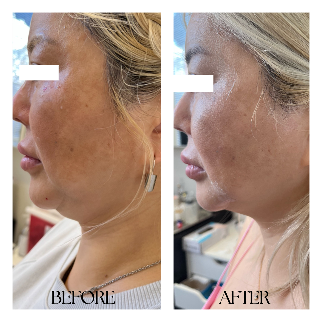 Excessive Fat Treatment - New Medical Spa