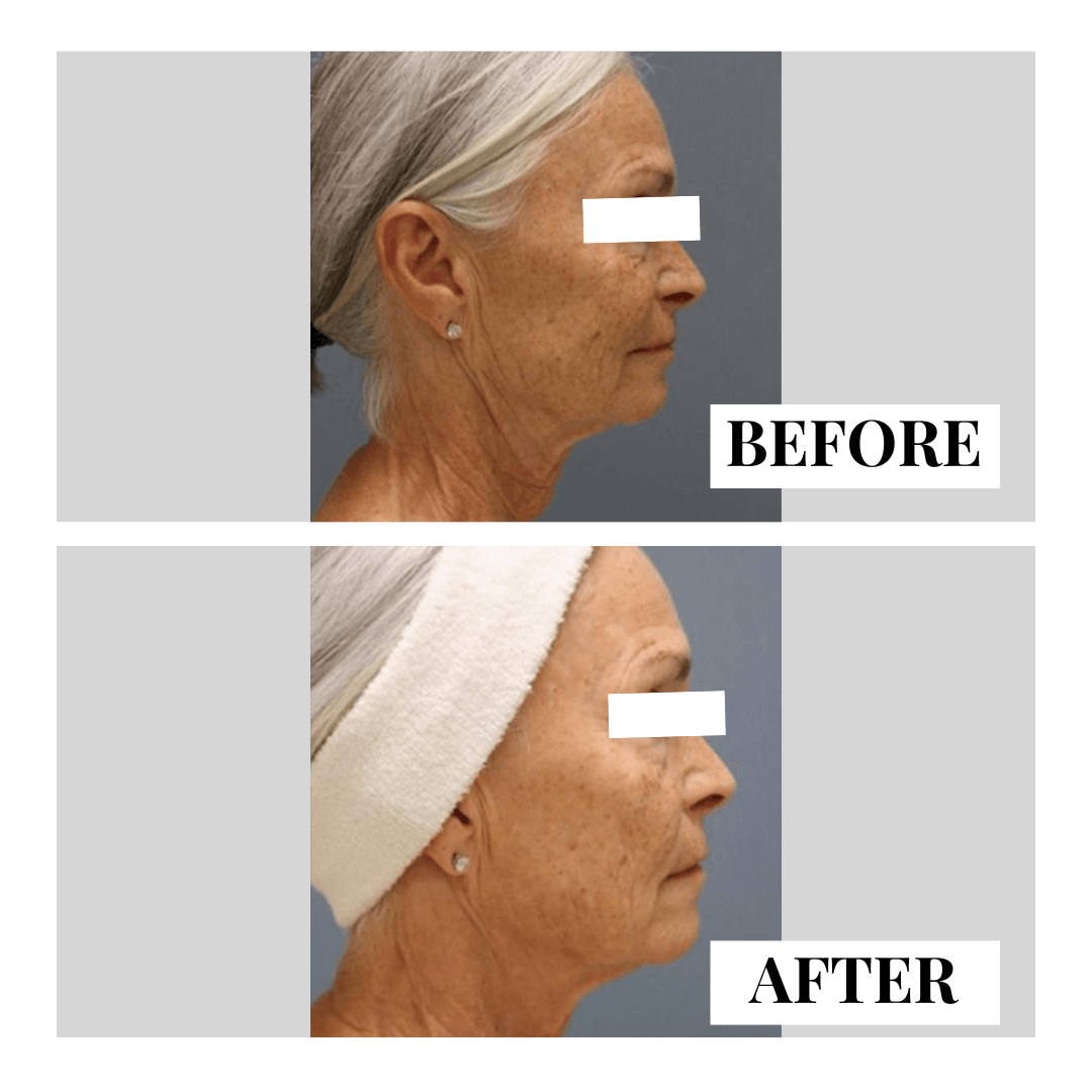 Solutions for Sagging Skin on the Body - New Medical Spa