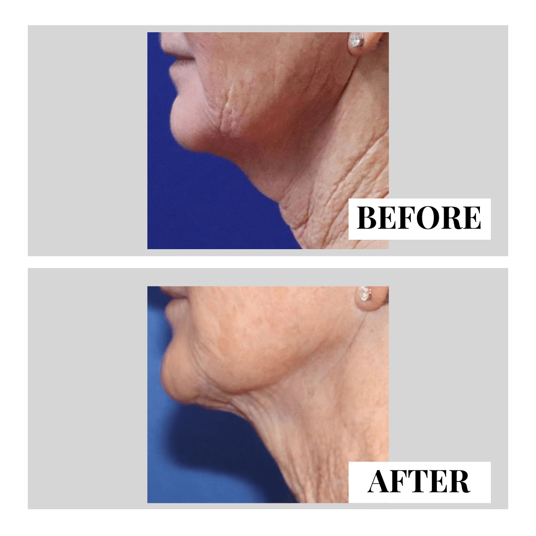 Solutions for Sagging Skin on the Body - New Medical Spa