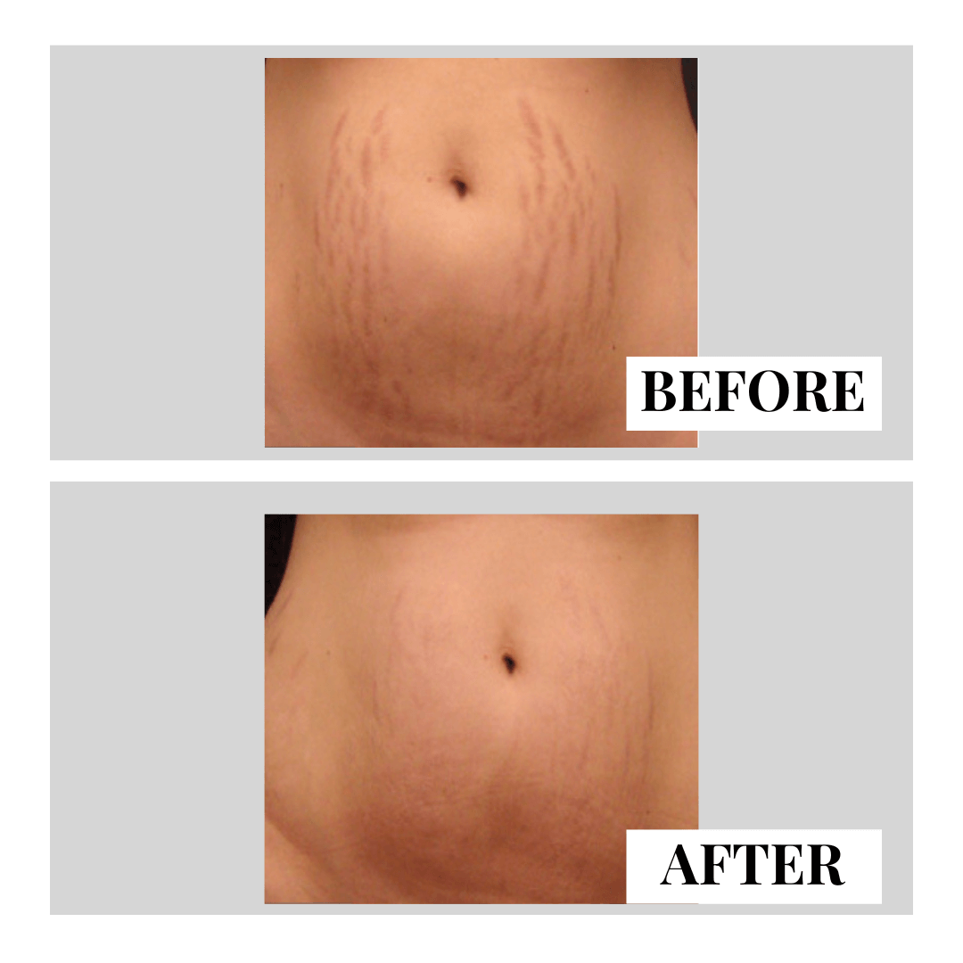 Stretch Marks Treatment Solutions - New Medical Spa
